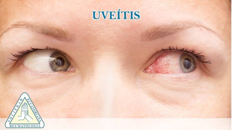 UVEÍTIS: QUÉ ES, SÍNTOMAS, DIAGNÓSTICO Y TRATAMIENTO · Sociedad ...